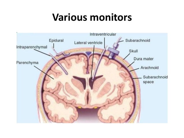 intracranial pressure monitoring