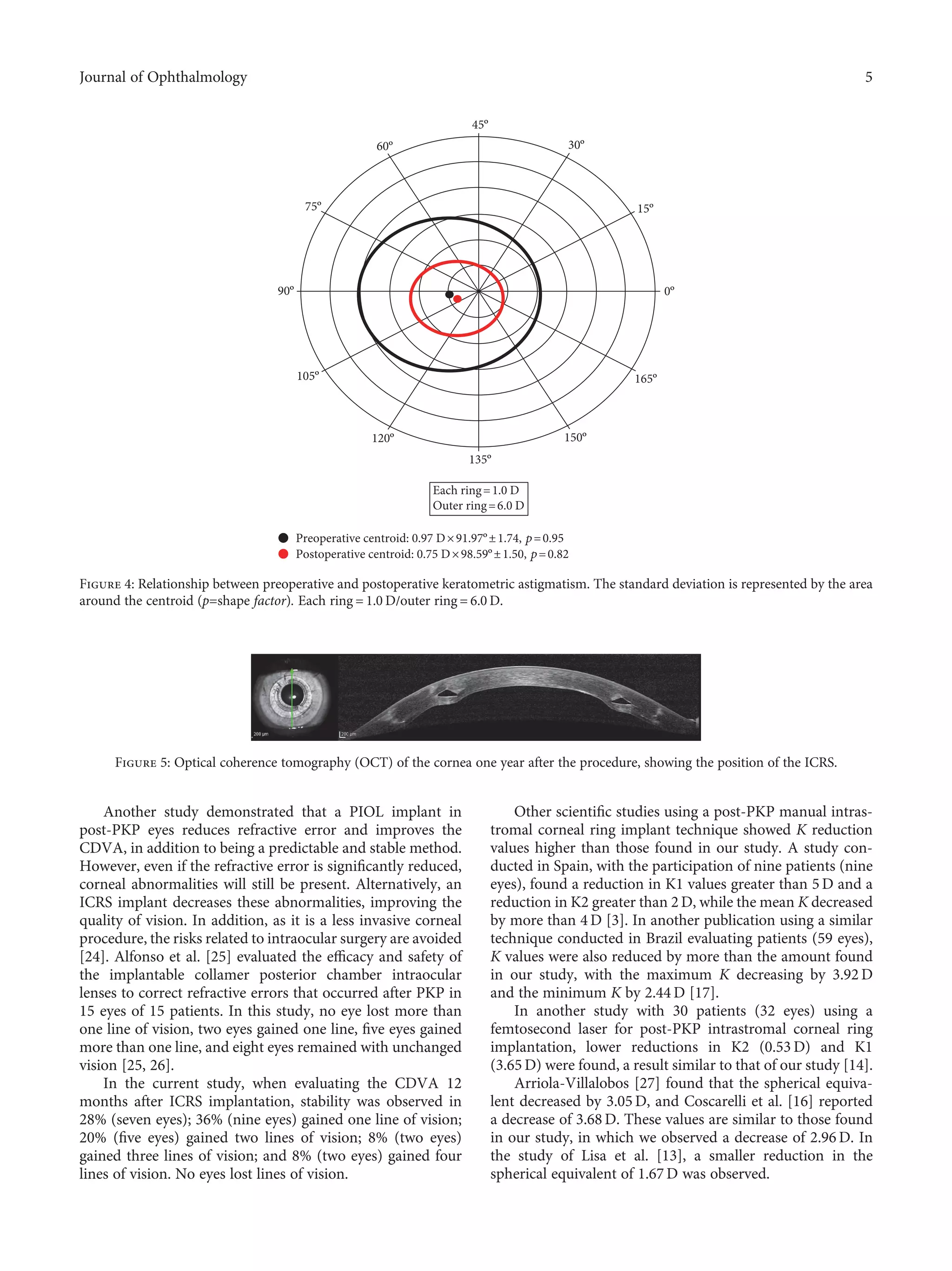 Ferrara Ring after DALK | PDF