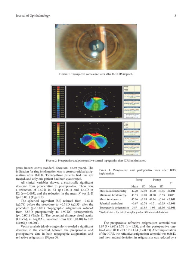 Ferrara Ring after DALK | PDF