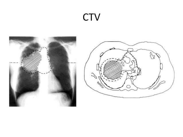 Icru reports in external beam radiotherapy | PPTX | Cancer | Diseases ...