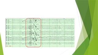 Ictal abnormalities.pptxvbcvbcbcbcbcbcbcbc | PPTX