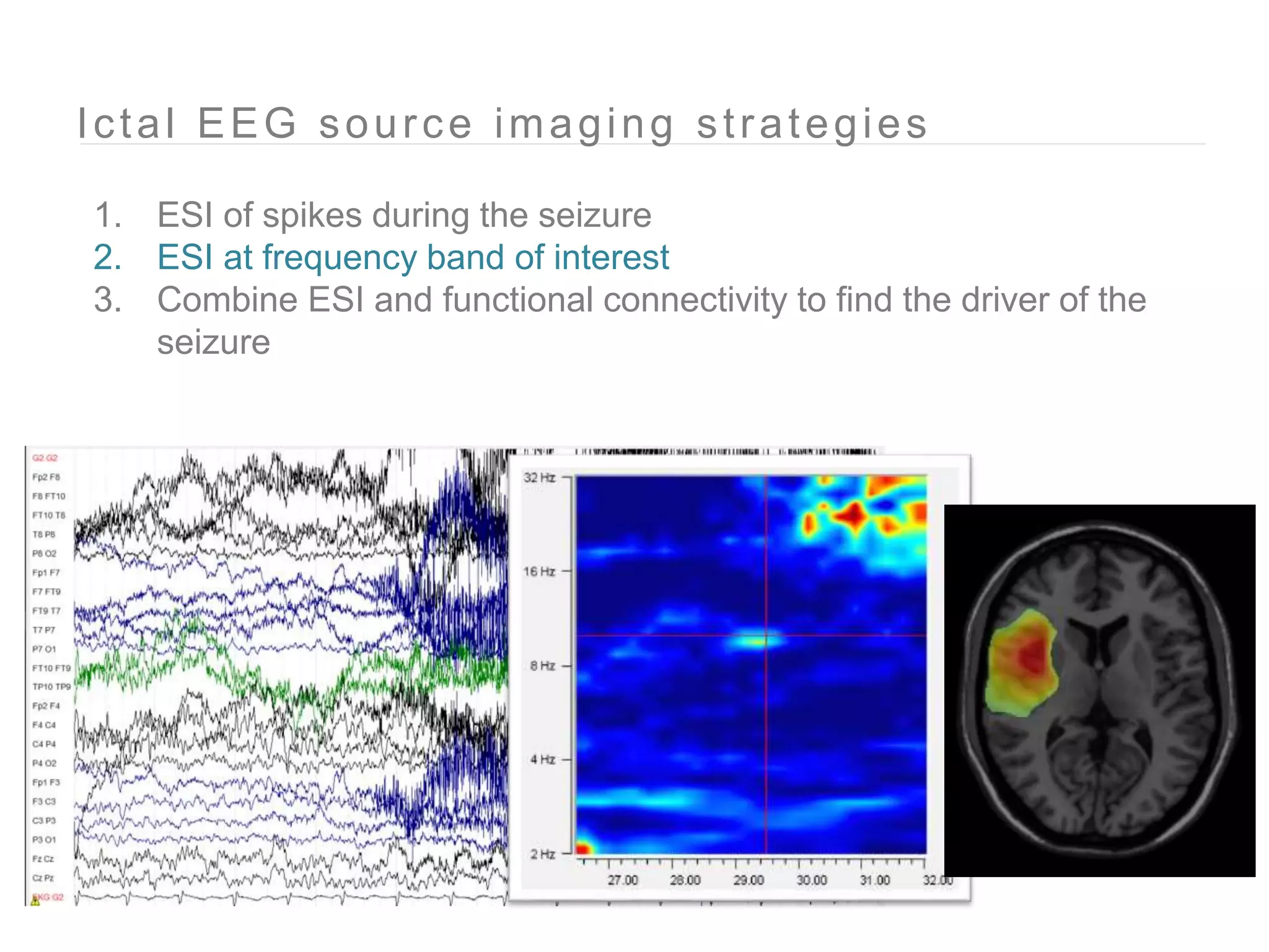 Ictal Eeg Source Imaging Pptx Brain And Nervous System Disorders