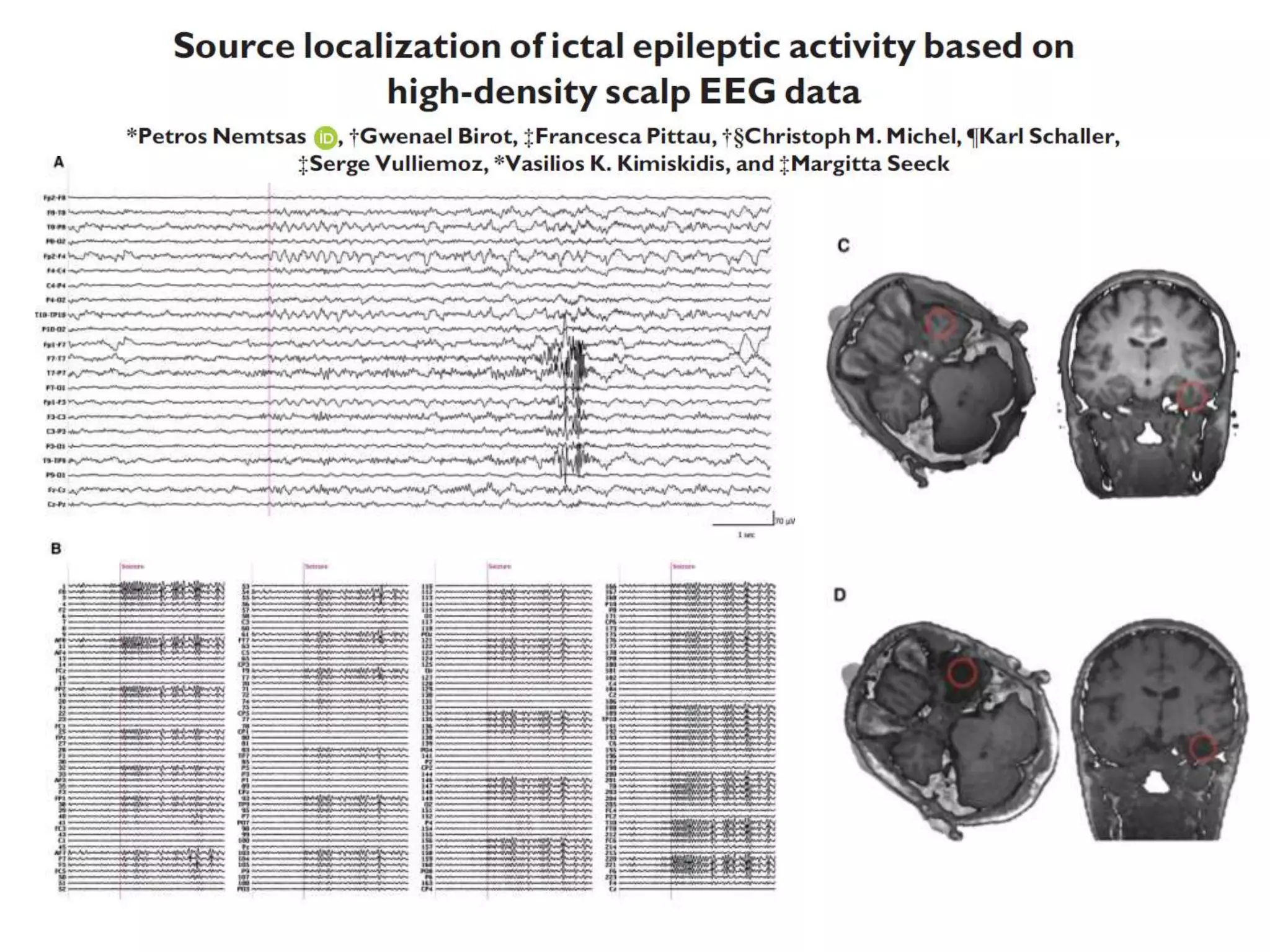 Ictal EEG source imaging | PPTX | Brain and Nervous System Disorders | Diseases and Conditions