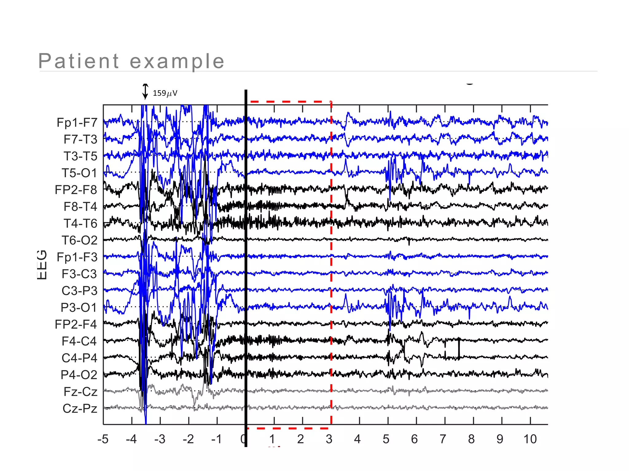 Ictal Eeg Source Imaging Pptx Brain And Nervous System Disorders