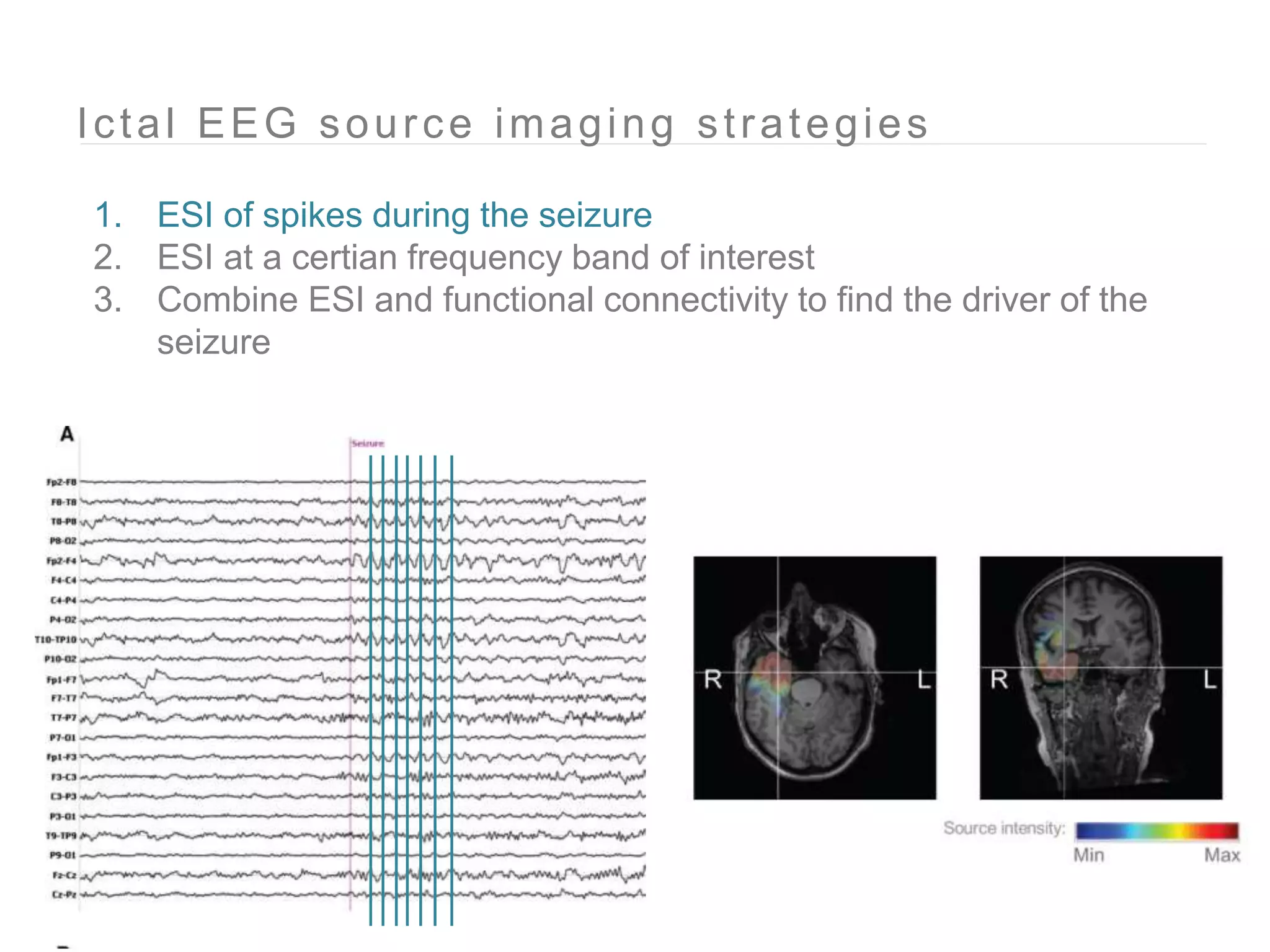 Ictal Eeg Source Imaging Pptx Brain And Nervous System Disorders