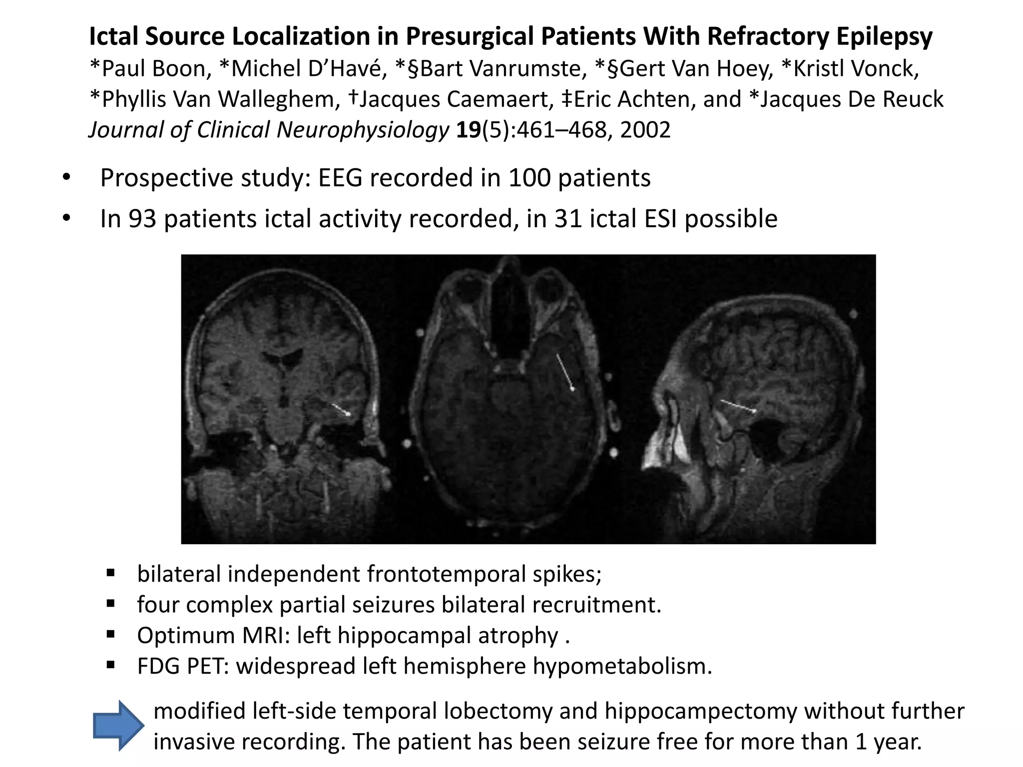 Ictal Eeg Source Imaging Pptx Brain And Nervous System Disorders