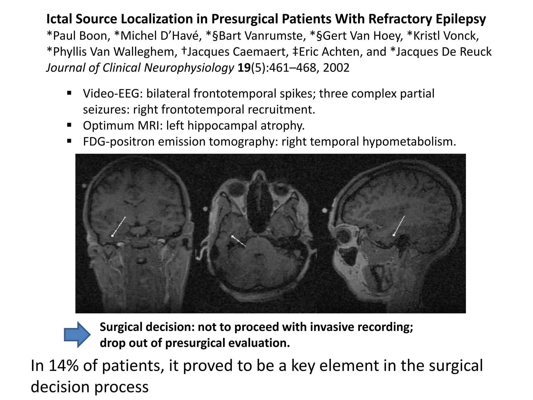 Ictal Eeg Source Imaging Pptx Brain And Nervous System Disorders