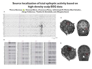 Ictal EEG source imaging | PPT