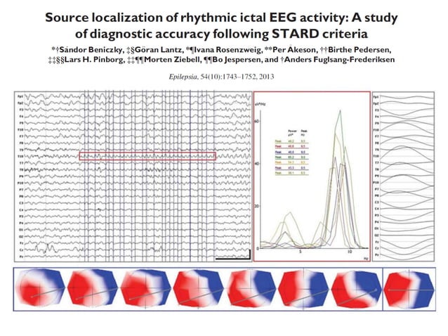 Ictal Eeg Source Imaging Pptx Brain And Nervous System Disorders