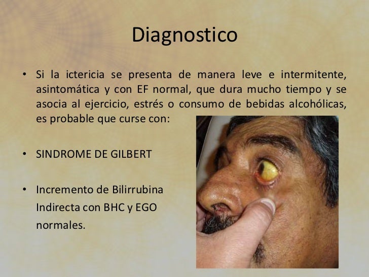 Ictericia