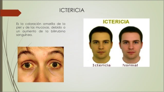 ICTERICIA