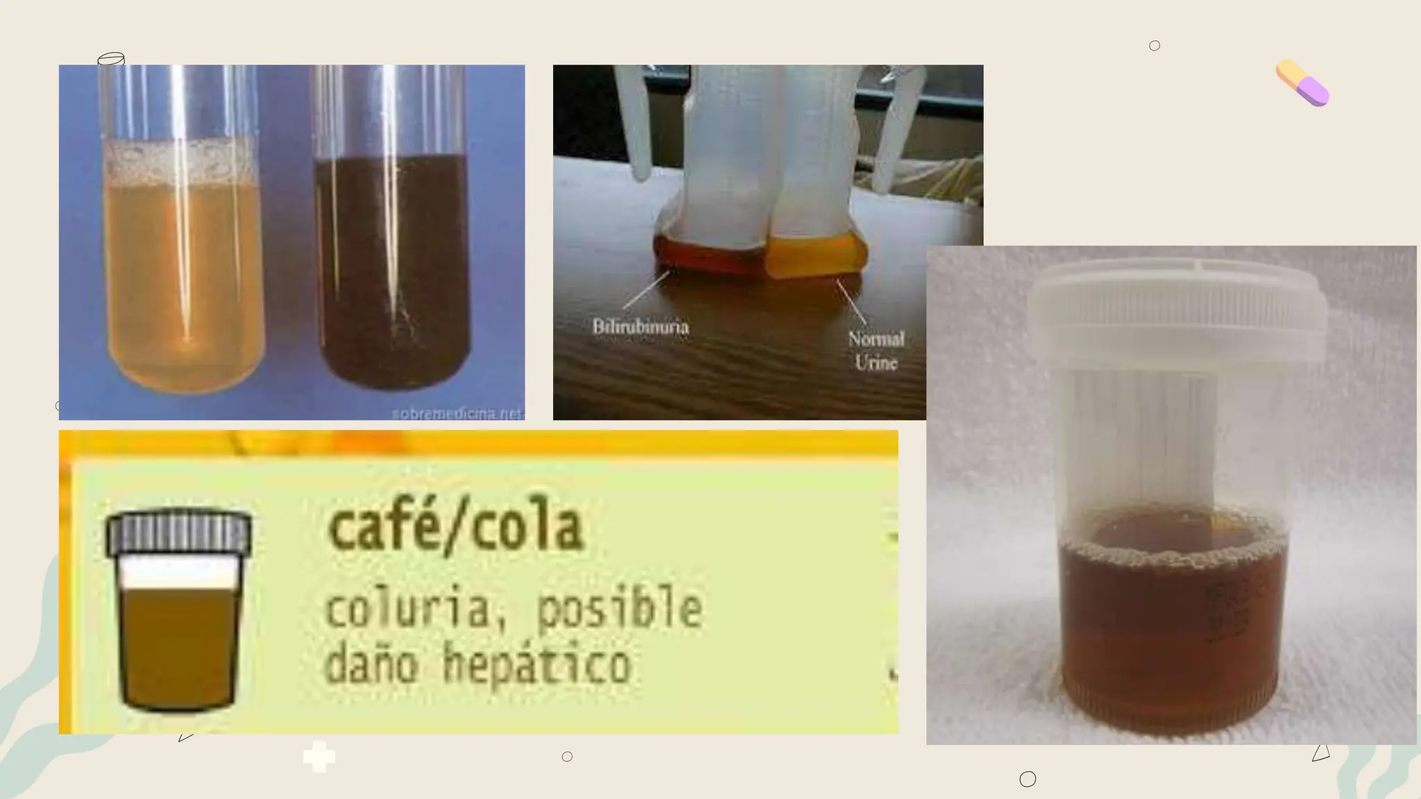 Clasificación de Ictericia, prehepatica, hepatica y posthepatica | PPTX