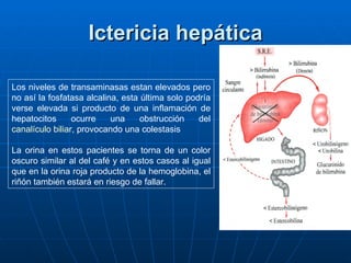 Fisiopatologia: Ictericia | PPT