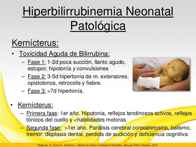 Ictericia del recien nacido