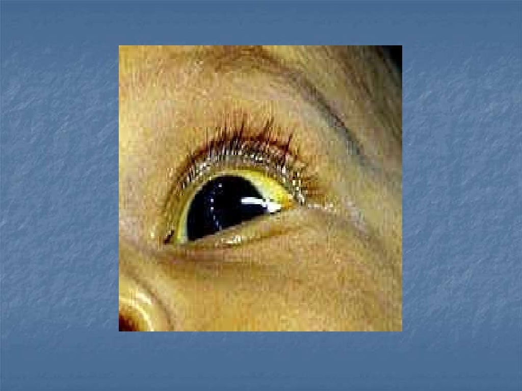 Ictericia fisiologica