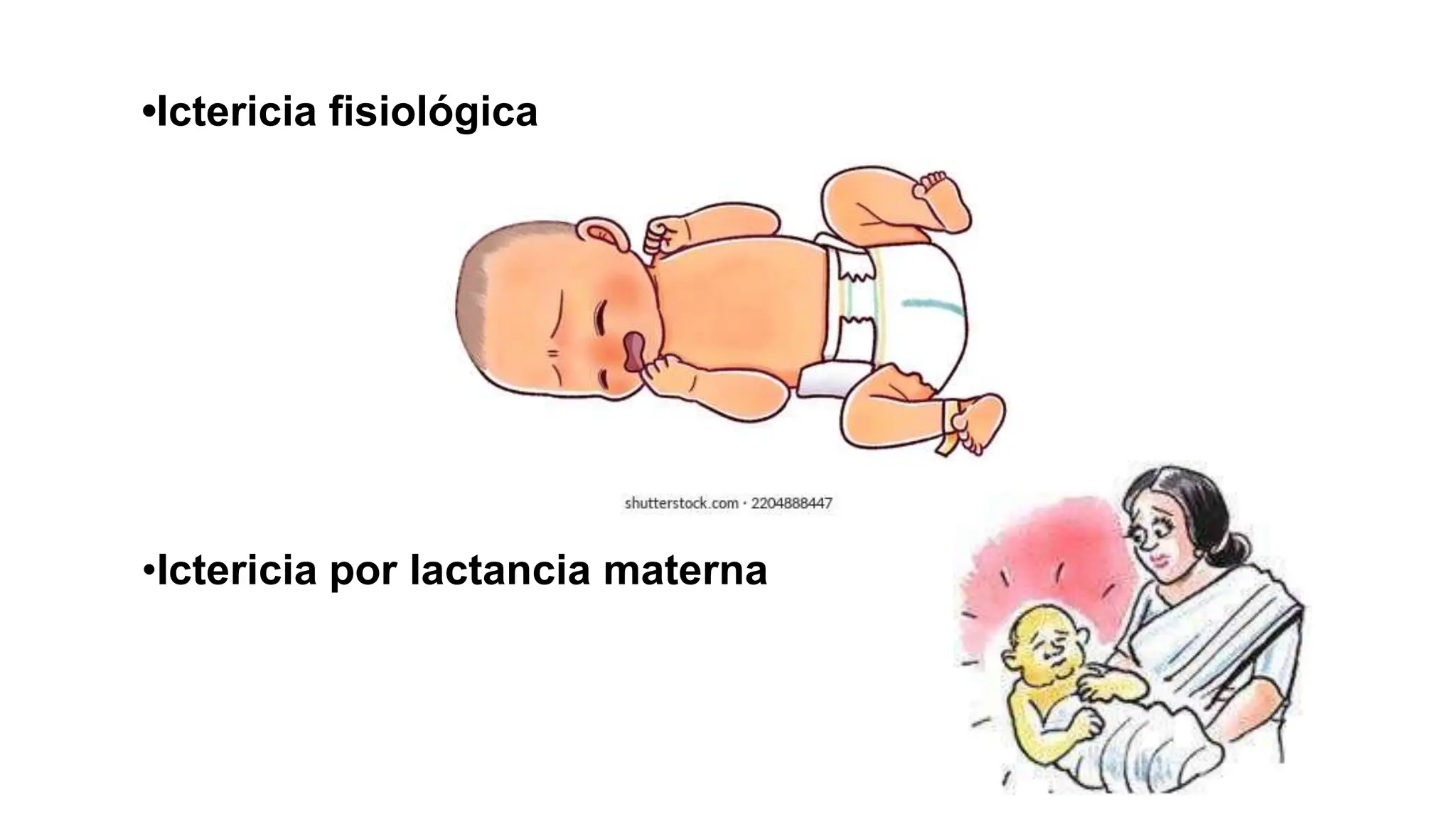 ICTERICIA NEONATAL-PEDIATRIA LOS PRIMEROS DIAS DE VIDA EN EL SER HUMANO ...