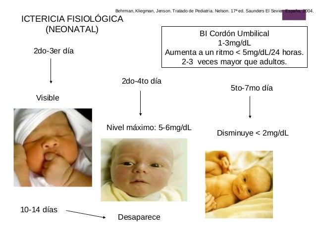 Ictericia neonatal