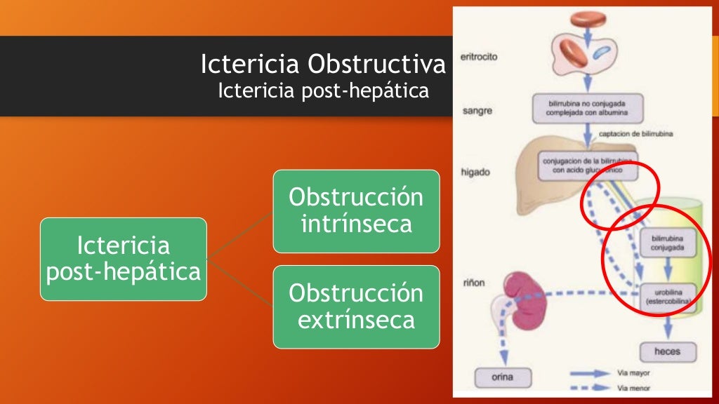 Ictericia obstructiva