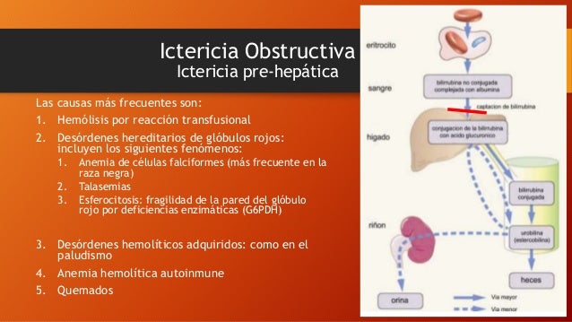 Ictericia obstructiva
