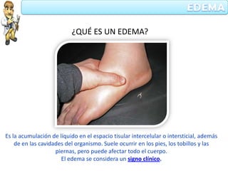 Ictericia y Edema | PPTX