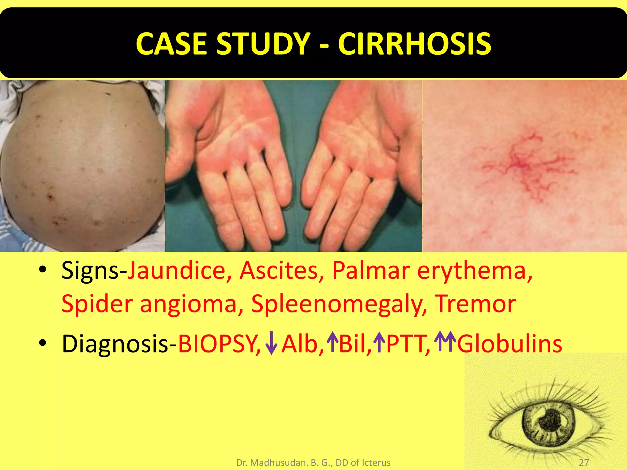 Differential Diagnosis of Icterus/Jaundice | PPTX