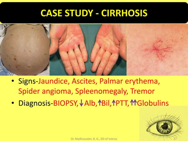 Differential Diagnosis of Icterus/Jaundice | PPTX | Blood Disorders ...