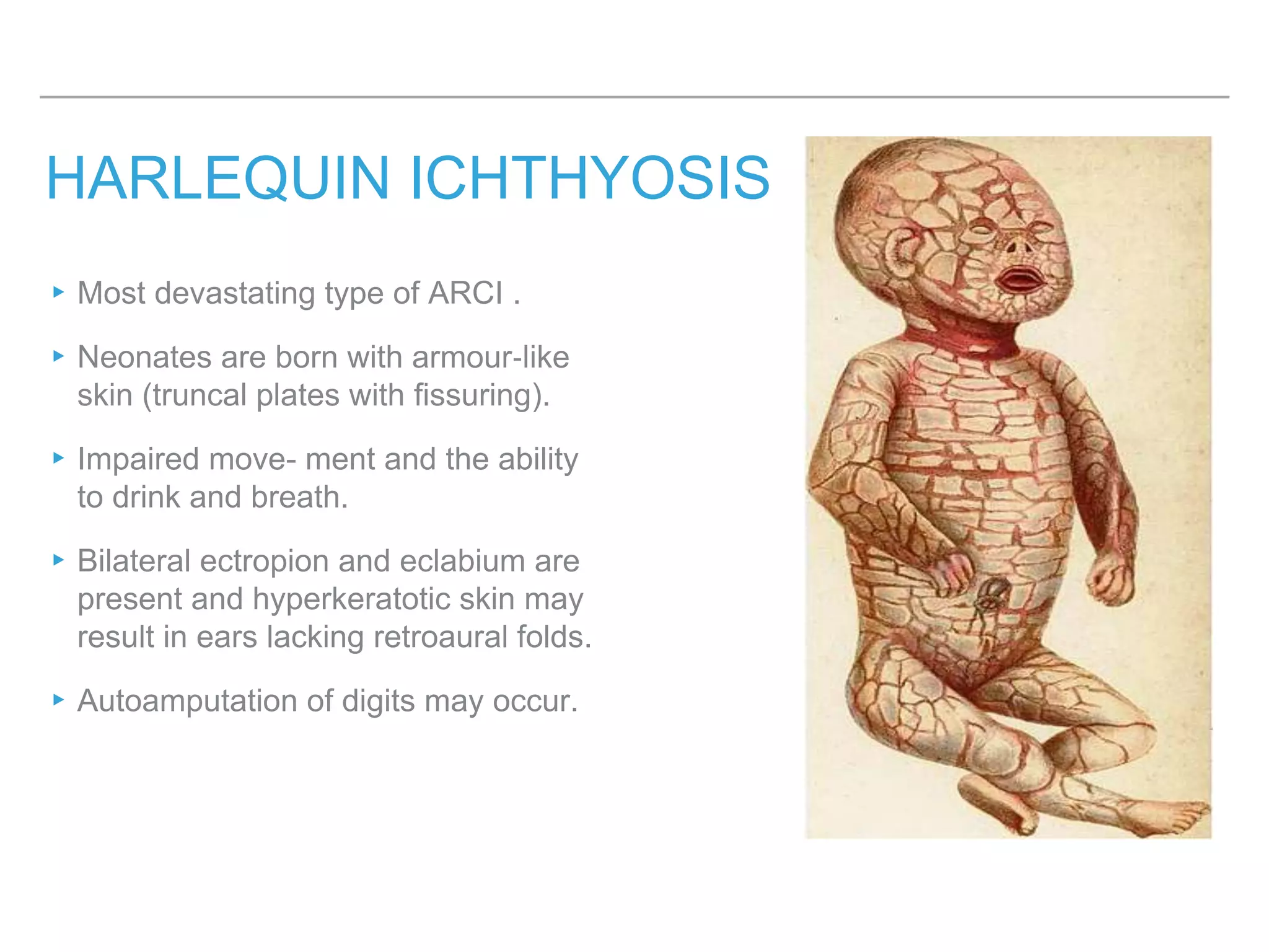 Icthyosis | PPTX