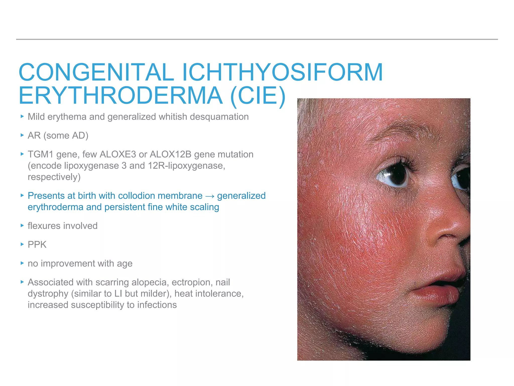 Icthyosis | PPTX