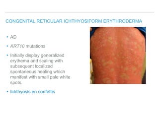 Icthyosis | PPTX