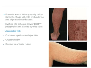 X Linked Ichthyosis Mild