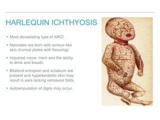 Harlequin Ichthyosis Diagram