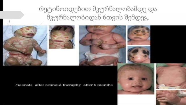 Ichthyosis | PPTX