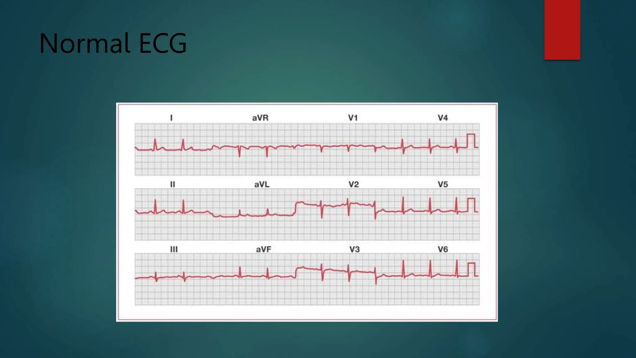 ICU - The ECG - ELECTROCARDIOGRAM.pptx