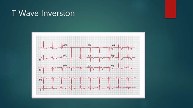 ICU - The ECG - ELECTROCARDIOGRAM.pptx