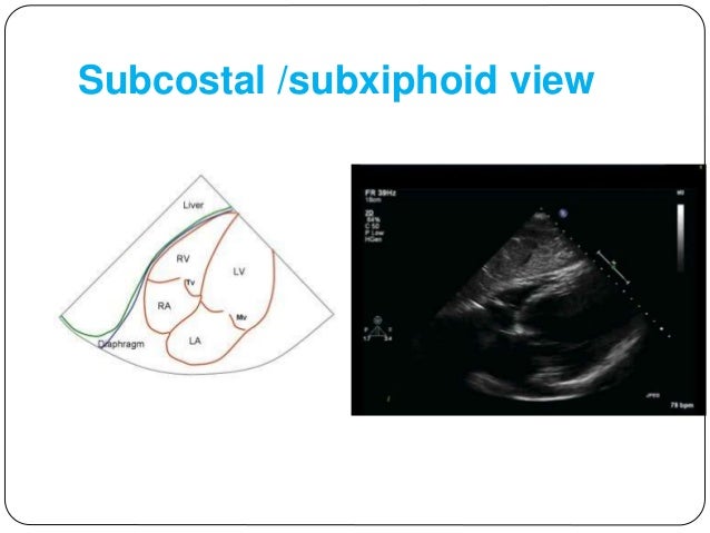 Subcostal Saggital View