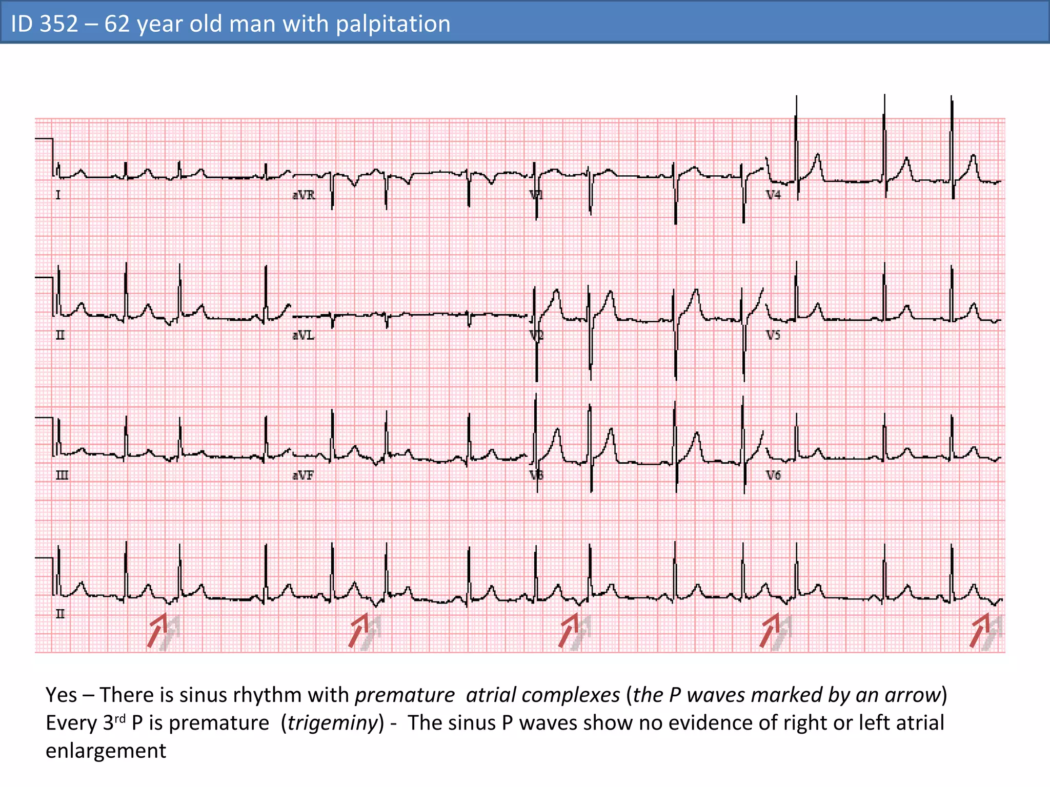 ID 352 –Sinus rhythm With premature atrial complex | PPT
