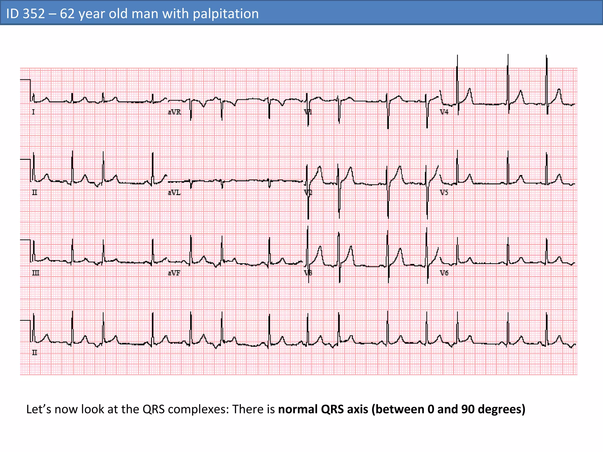 ID 352 –Sinus rhythm With premature atrial complex | PPT