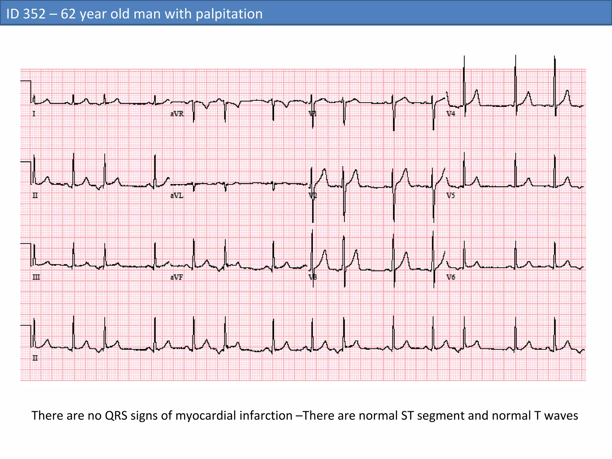 ID 352 –Sinus rhythm With premature atrial complex | PPT