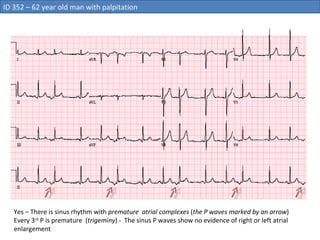ID 352 –Sinus rhythm With premature atrial complex | PPT