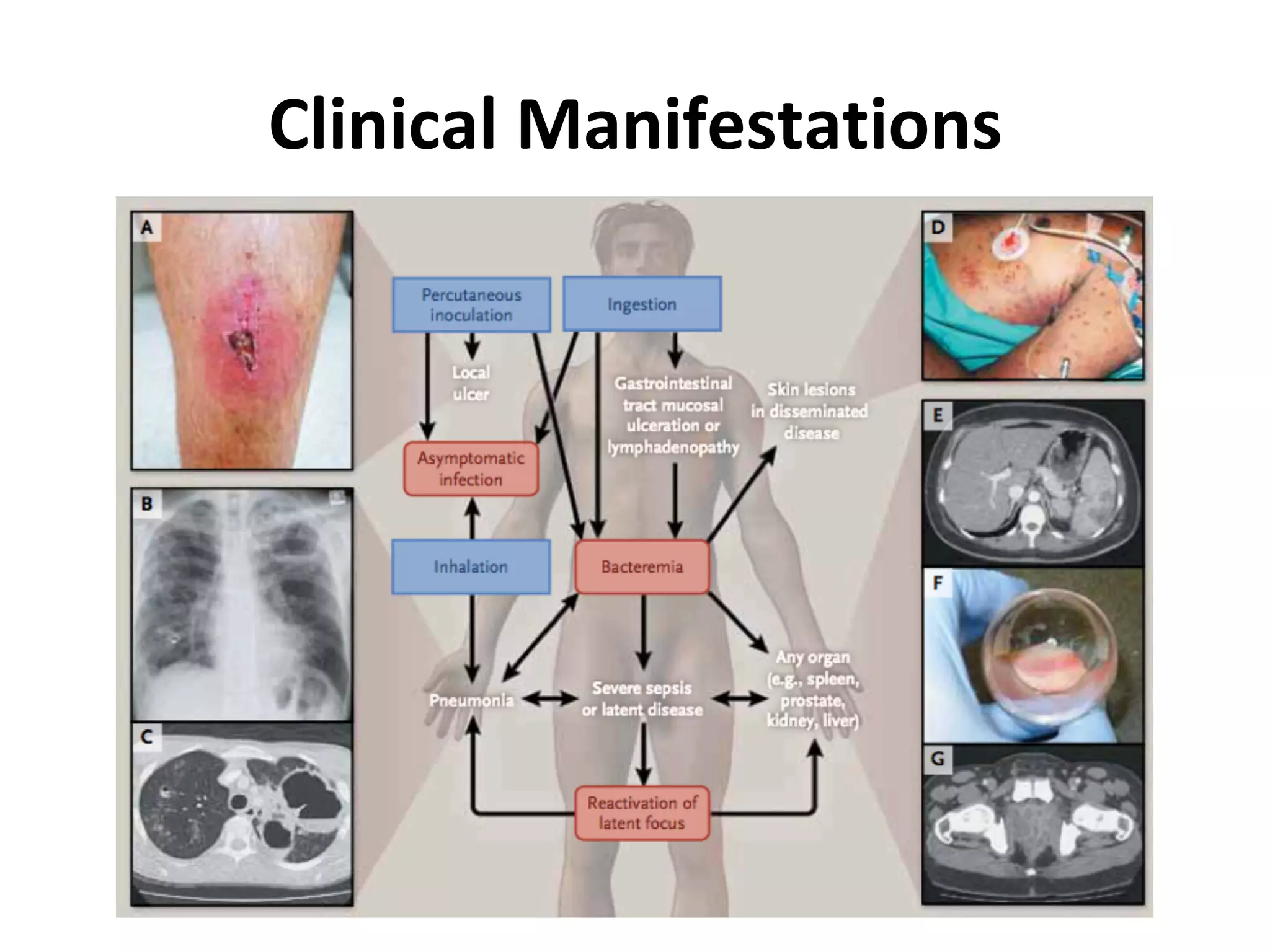 Melioidosis, Whitmore's disease | PDF