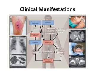 Melioidosis, Whitmore's disease | PPT