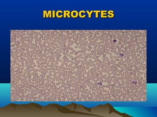 Iron Deficiency Anemia/Dr. Youssef Quda | PPT