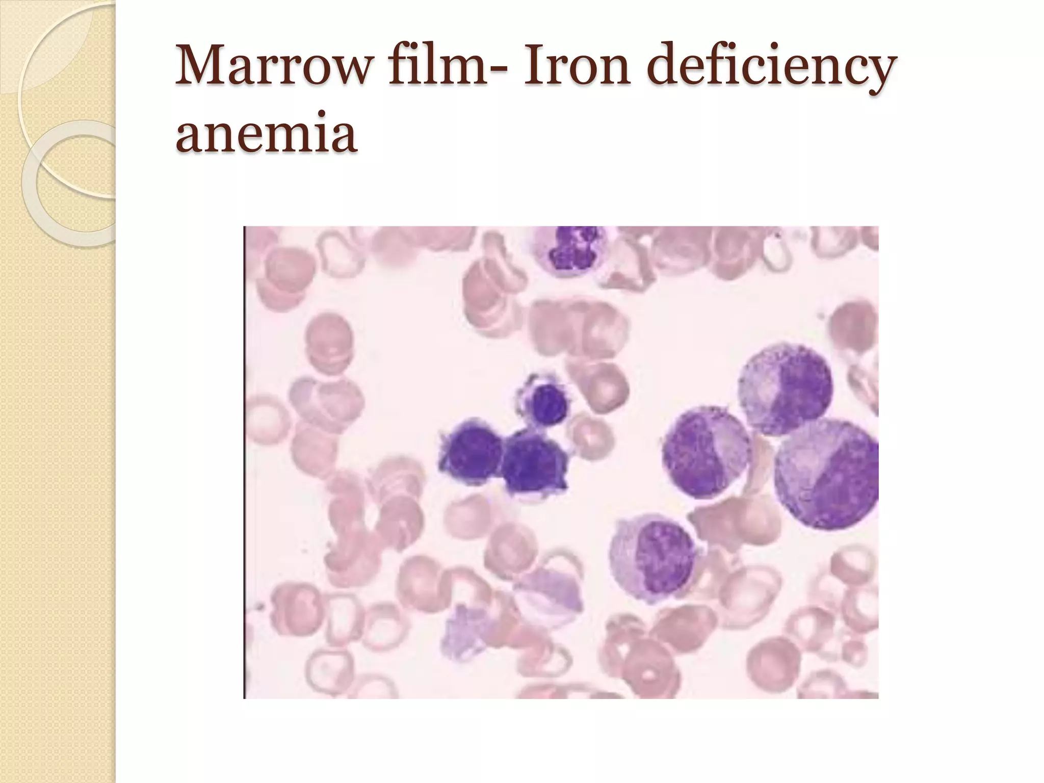 IRON DEFICIENCY ANEMIA | PPTX
