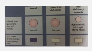 Iron Deficiency anemia powerpoint presentation | PPTX