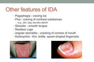 Iron deficiency anemia management, risk factors, physiology of iron ...