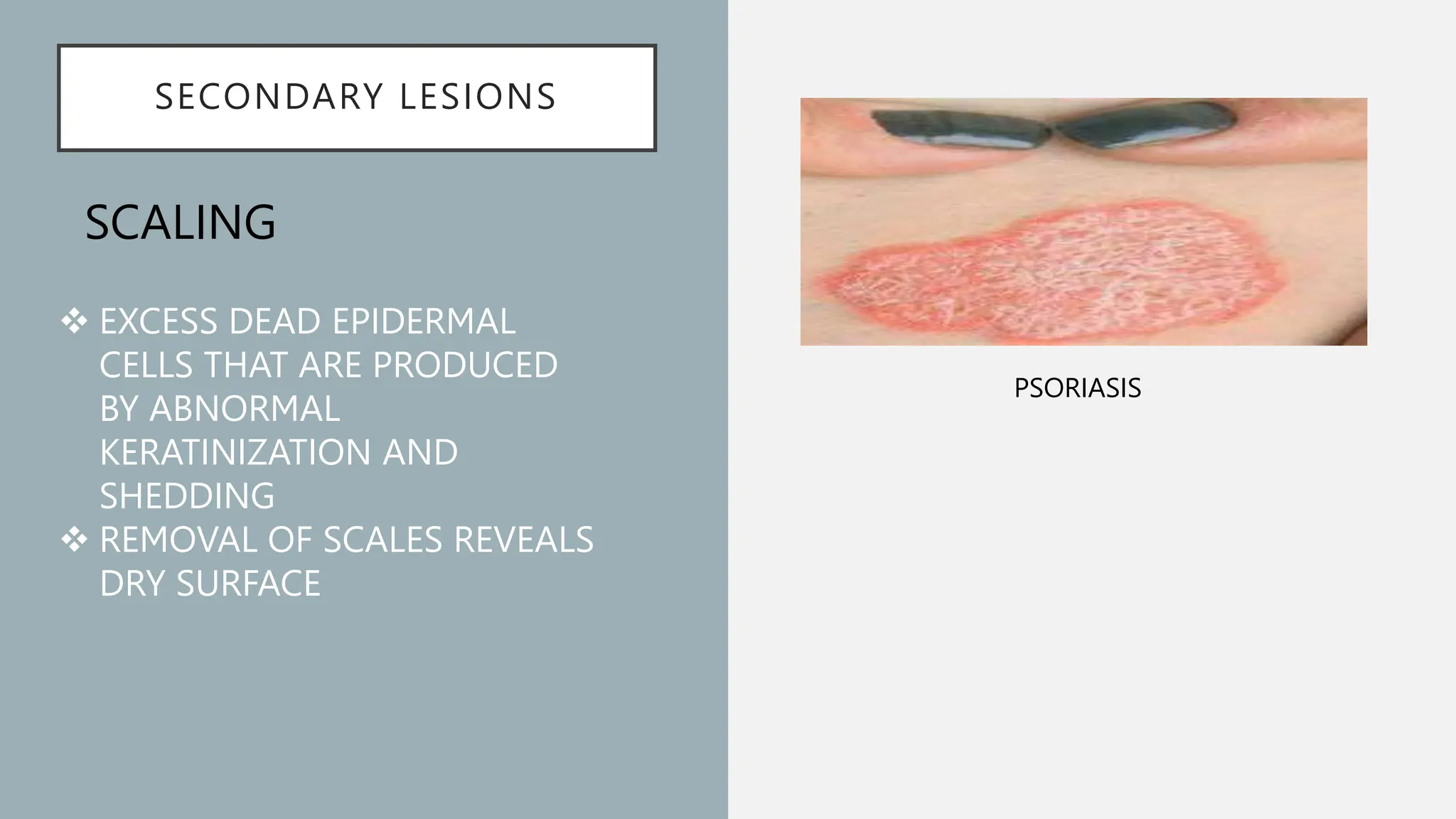 Dermatology. Basic skin leisons ( primary and secondary)pptx | PPTX
