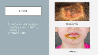Dermatology. Basic skin leisons ( primary and secondary)pptx | PPTX