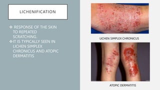 Dermatology. Basic skin leisons ( primary and secondary)pptx | PPTX