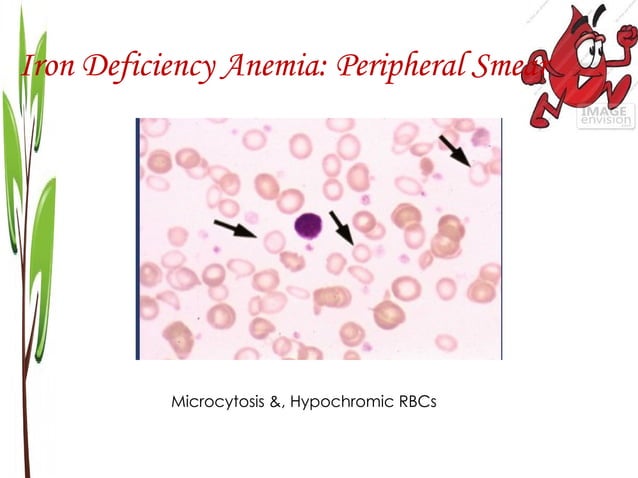 Iron Deficiency anemia clinical presentation and management | PPTX