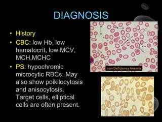IRON DEFICIENCY ANAEMIA | PPTX